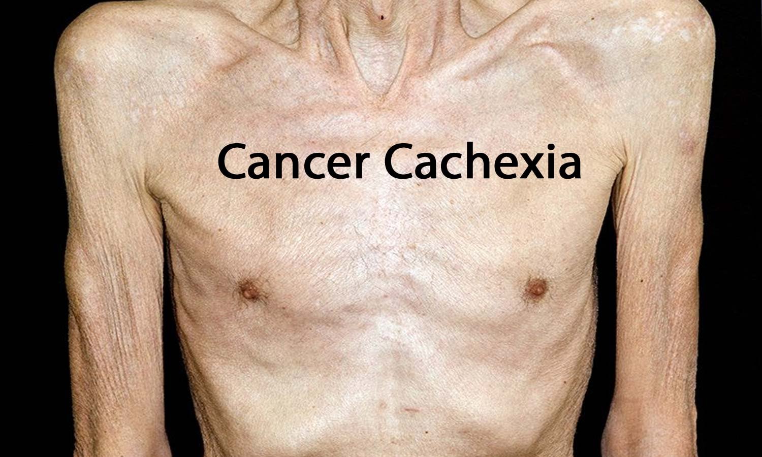 CANCER CACHEXIA: Beyond Weight Loss. - Cancer Biogenomics
